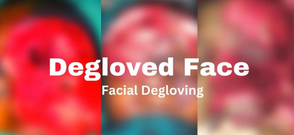 Degloved Faces: Causes, Treatment And Recovery